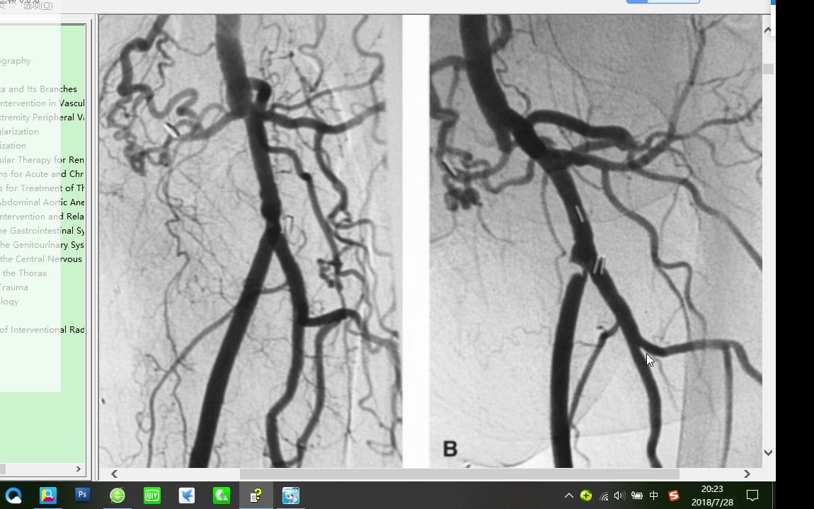三千四百元的教科书 Abrams' Angiography-6 下肢动脉造影-2 20180728-202122449_哔哩哔哩 (゜-゜)つロ 干杯~-bilibili