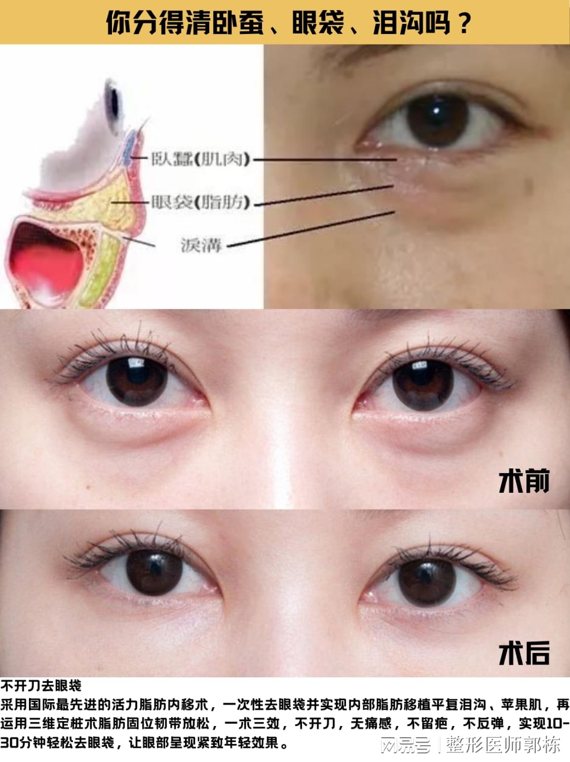 郭栋不开刀去眼袋 4种去眼袋方法哪个好 哔哩哔哩