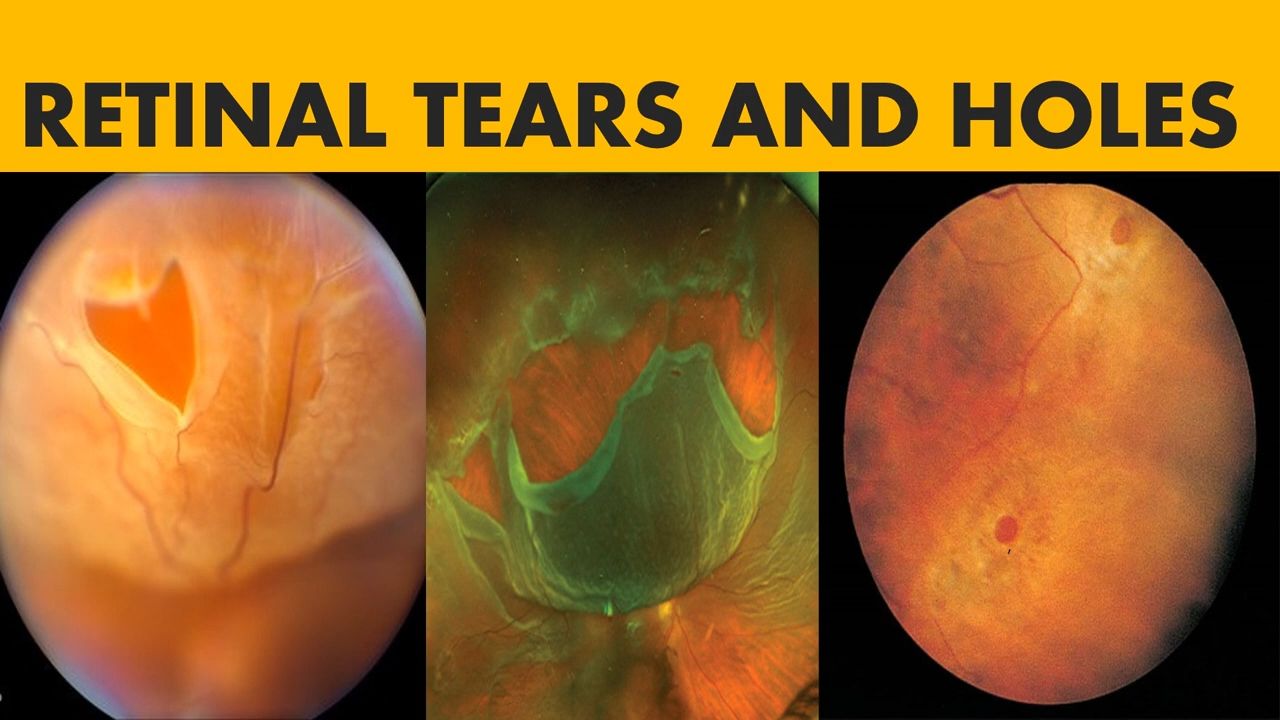 Retinal Breaks | Horseshoe shaped Tears, Atrophic holes, operculated ...