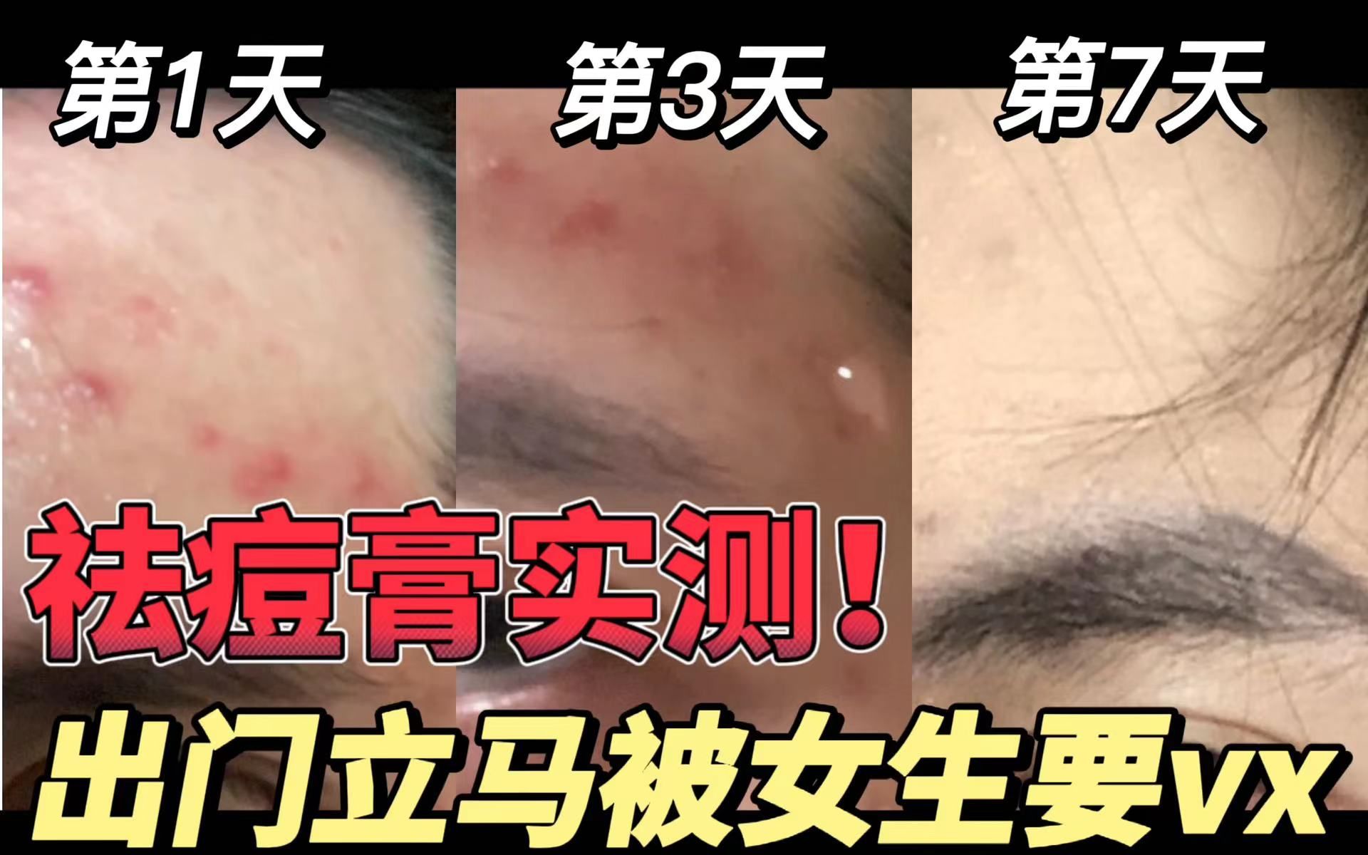 快速战痘全网火爆的凝胶真的太狠了!不到一顿火锅钱!7天就能搞定痘痘闭口! 哔哩哔哩