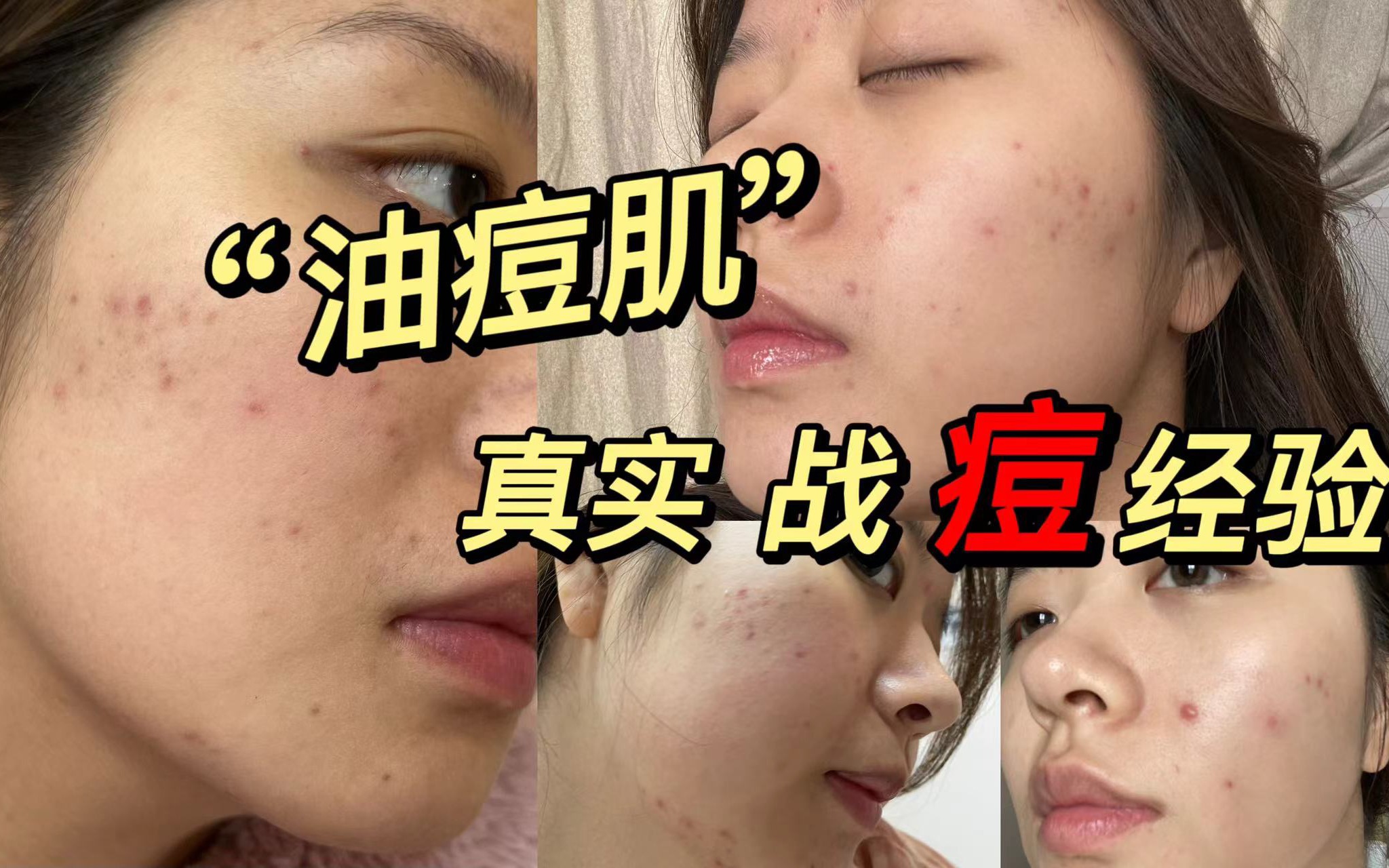 【油痘肌看过来】但凡早点知道它,都不至于那么遭罪 哔哩哔哩