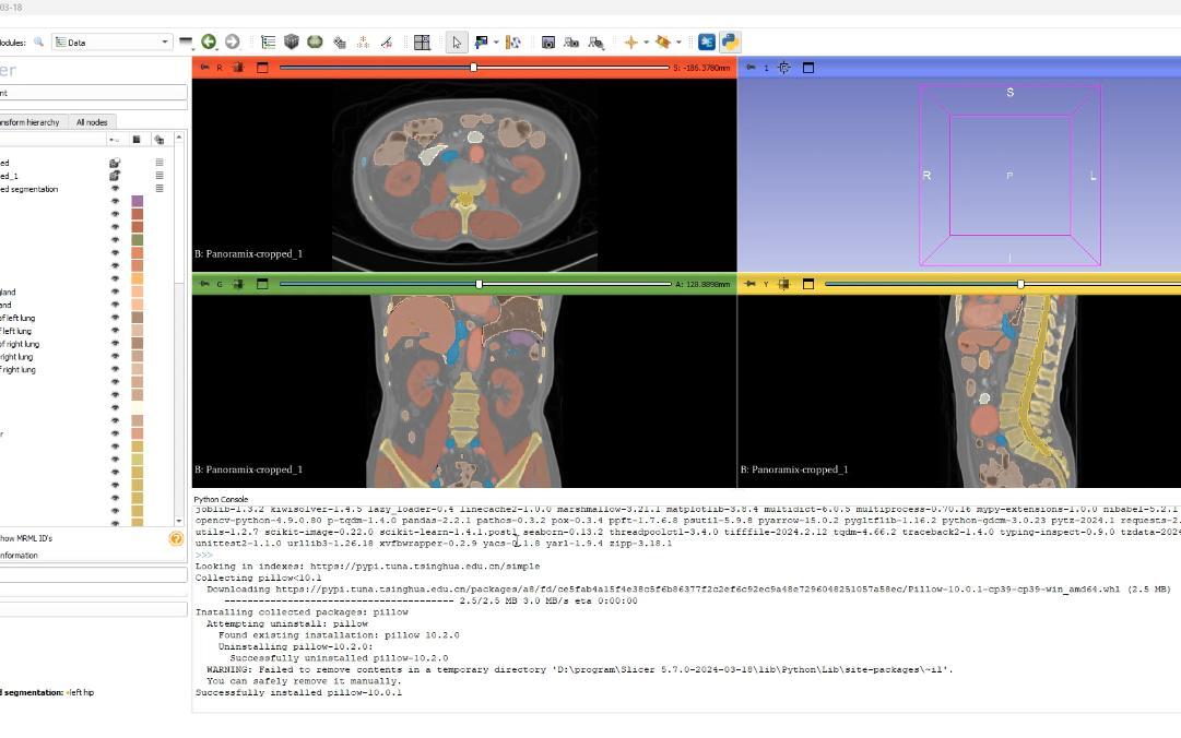 使用TotalSegment 模块 在3D Slicer中分割人体所有器官和骨骼 - 哔哩哔哩