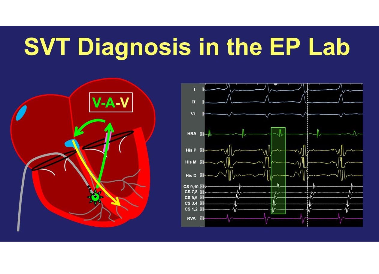 Diagnosis of SVT in the EP lab-Doctorwu002- SVT in EP-哔哩哔哩视频