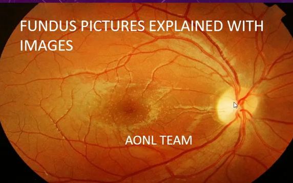 Fundus images explained by an ophthalmologist_哔哩哔哩_bilibili