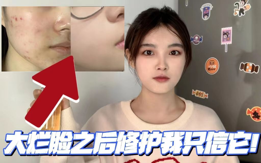 烂脸爆发期,还好我遇见了它拯救了我的焦虑!! 哔哩哔哩