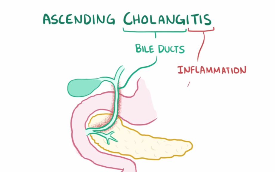 【搬运osmosis】Ascending cholangitis (acute cholangitis)_哔哩哔哩 (゜-゜)つロ 干杯 ...