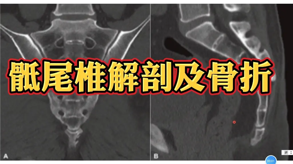 骶尾椎CT解剖及骨折影像表现，初学者必看的讲解！_哔哩哔哩_bilibili