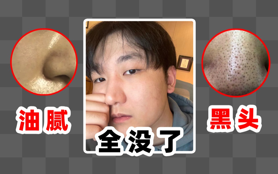 对象嫌弃?脸上油腻长黑头?做回干净清爽真男人,摆脱油!腻!脏! 哔哩哔哩