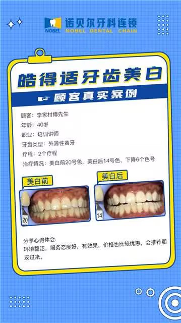 牙齿美白真实案例，美白前后对比 哔哩哔哩
