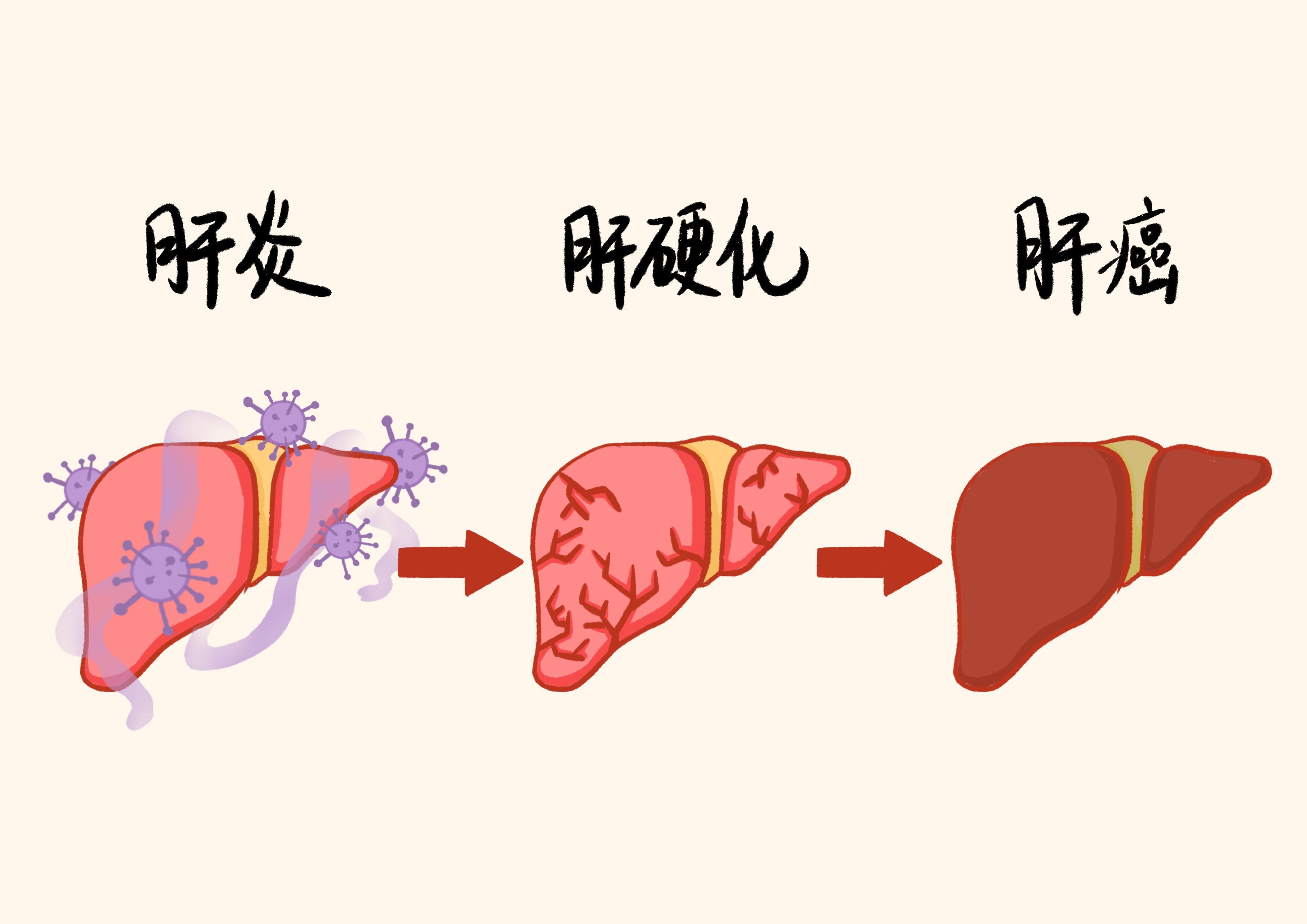 肝炎到肝癌只需4步，不想乙肝变成肝癌，做好这六 忌” 哔哩哔哩