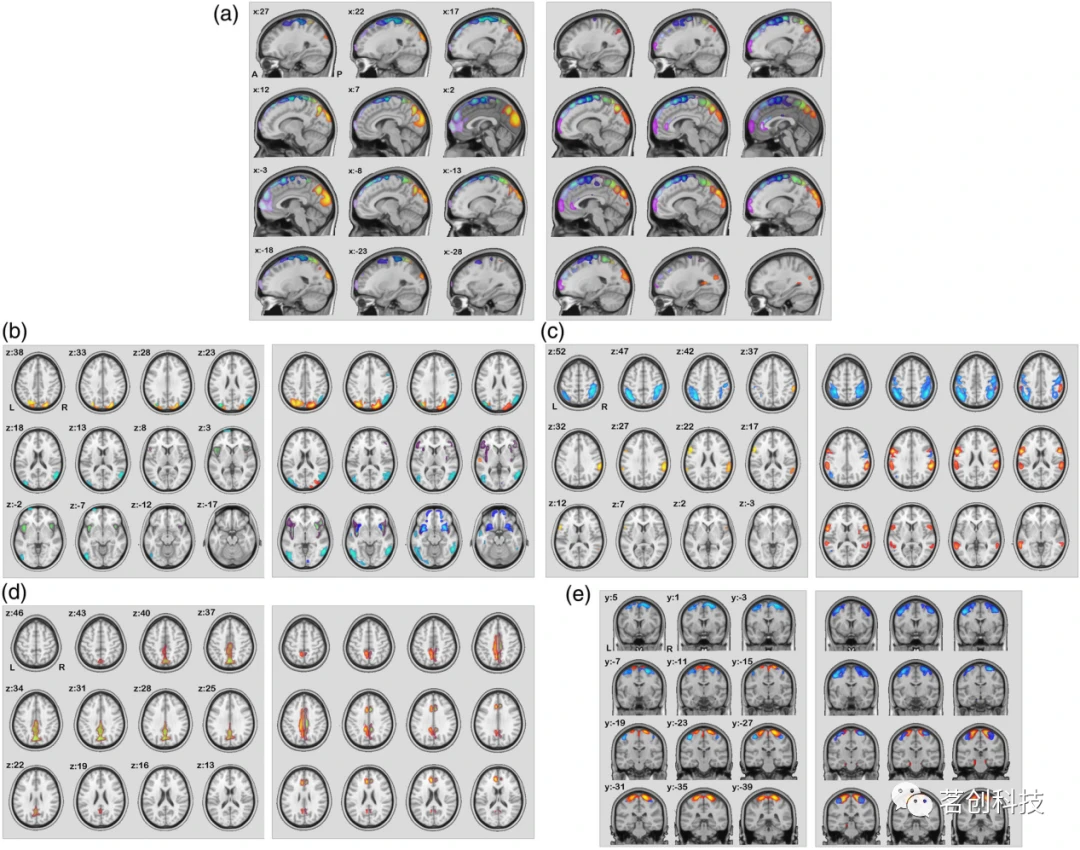 Hum Brain Mapp | 联合连接矩阵独立成分分析：结构和功能连接的自动链接 - 哔哩哔哩