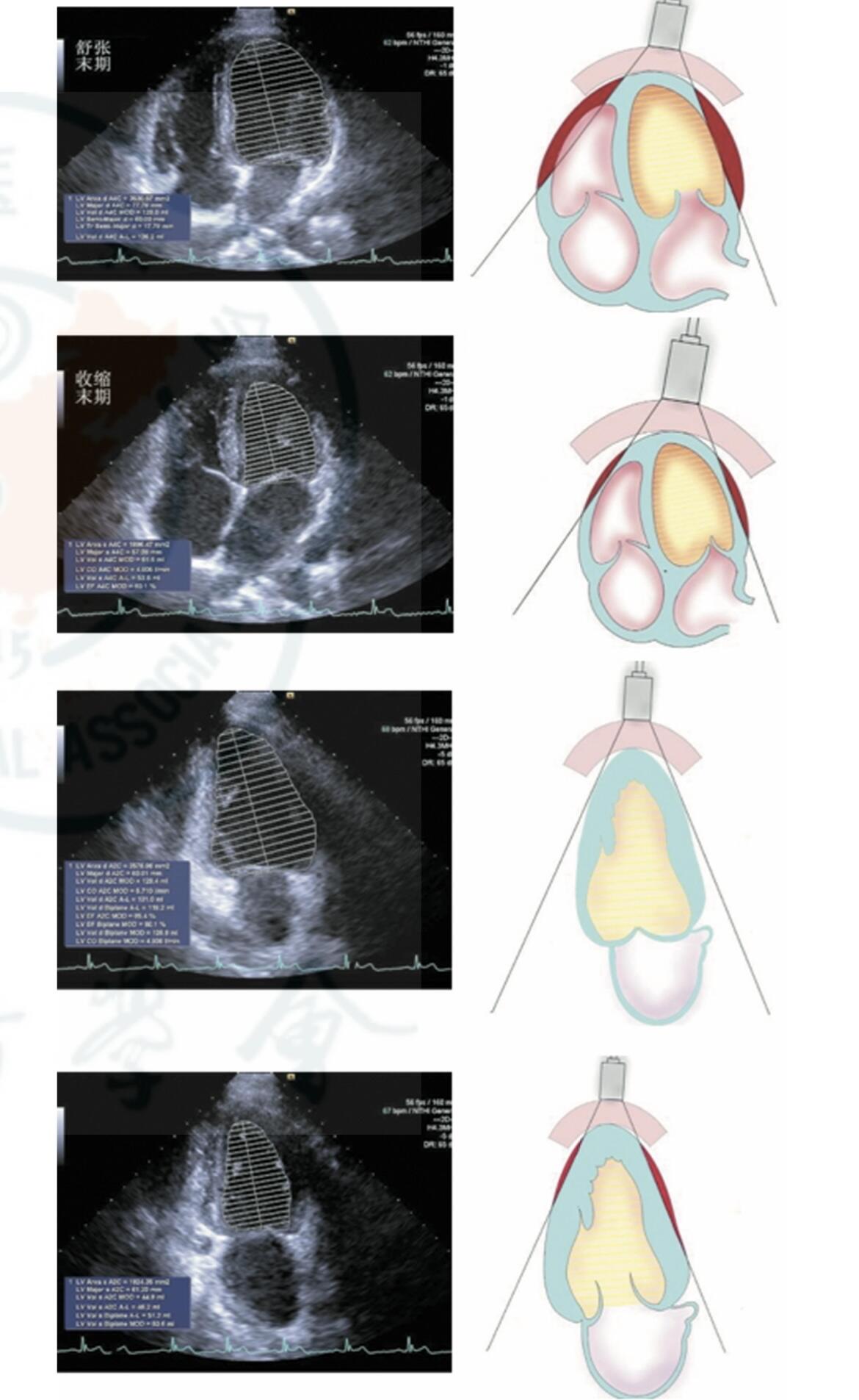 心脏超声-细讲左心室射血分数 (LVEF) - 哔哩哔哩
