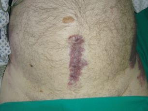 耳熟能详的 Cullen 征和 Grey-Turner 征，不止见于急性胰腺炎 - 哔哩哔哩