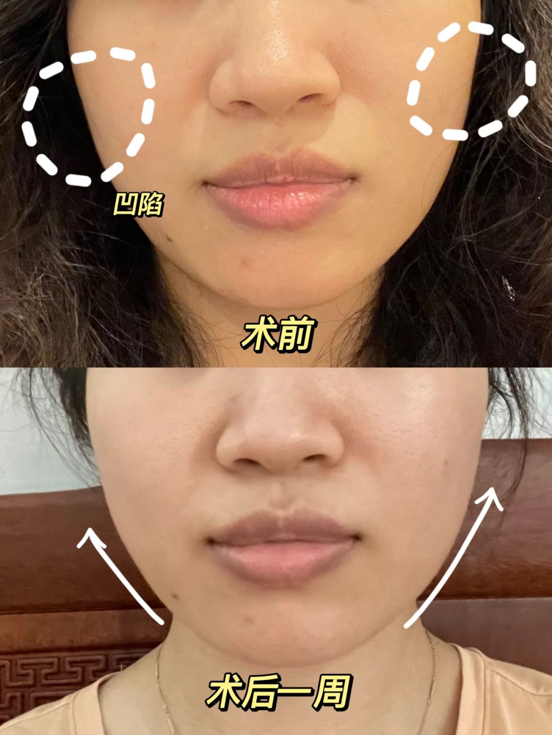 做了超声炮7天了脸颊还肿,超声炮副作用有哪些? 哔哩哔哩