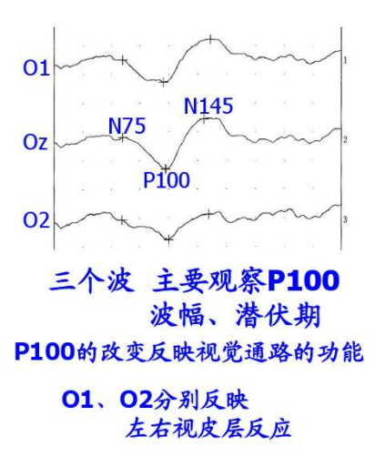视觉诱发电位检查 - 哔哩哔哩