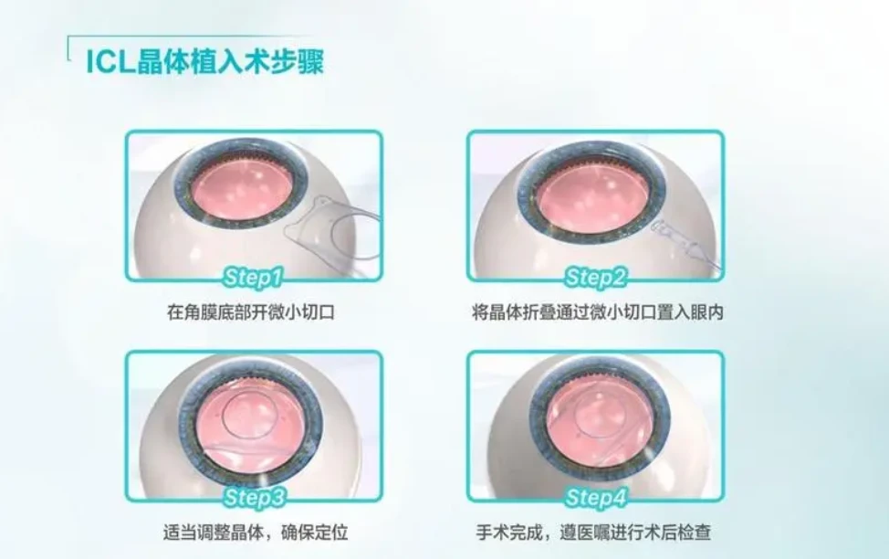 西安ICL晶体植入近视手术全攻略分享（超详细）-费用+效果+检查手术 - 哔哩哔哩
