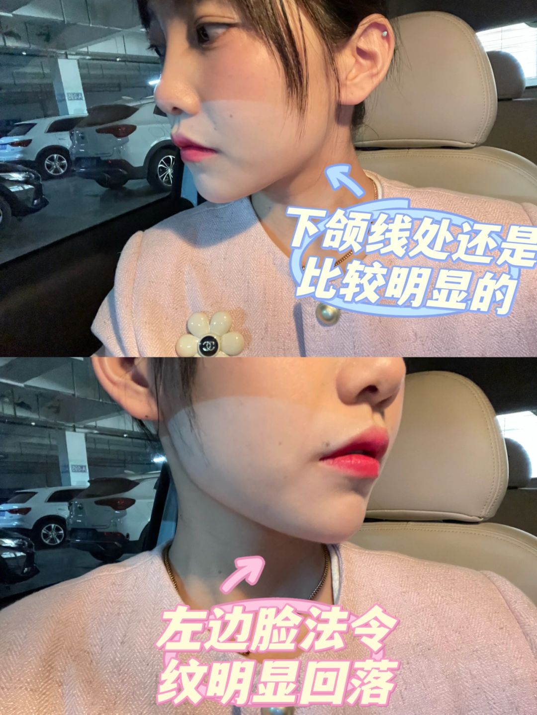 做超声炮会不会加速衰老,做一次超声炮能维持多久~ 哔哩哔哩