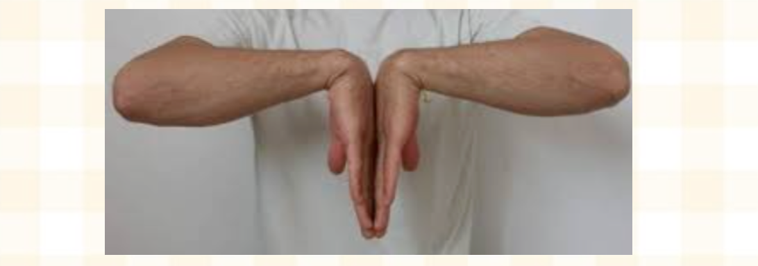 Phalen’s Test/腕管综合征 - 哔哩哔哩