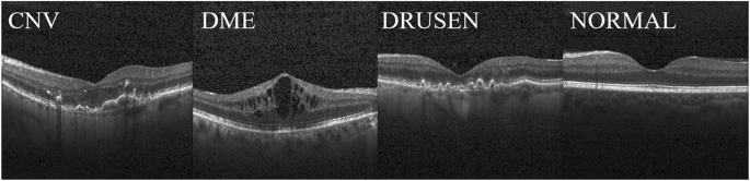 OCT的应用与解读 NOTE（二） - 哔哩哔哩
