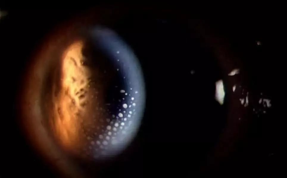 121招飞体检常见眼科淘汰疾病：角膜KP - 哔哩哔哩