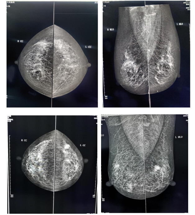 【健康科普讲堂】乳腺钼靶 精准 揪”出乳腺癌 定期检查是关键 哔哩哔哩
