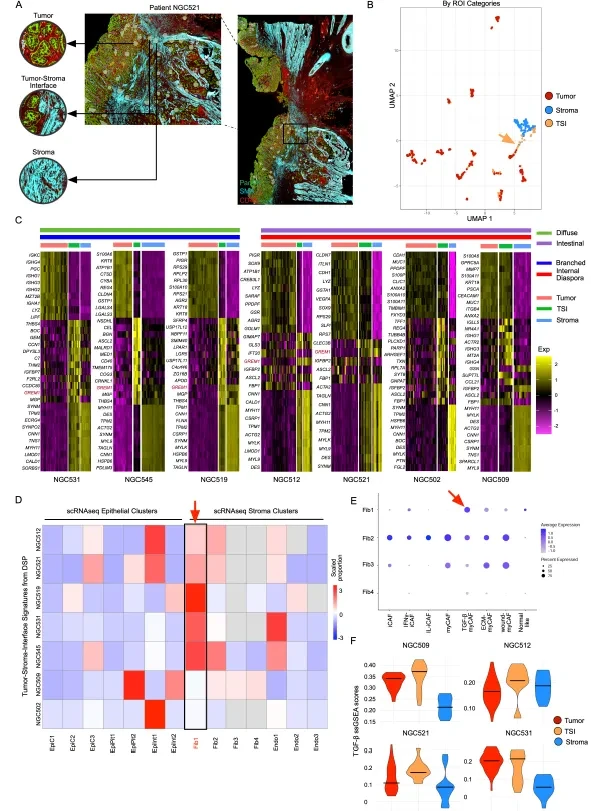 Cancer Discovery | Stereo-seq助力揭示胃癌发展过程中的空间异质性及细胞状态变化 - 哔哩哔哩
