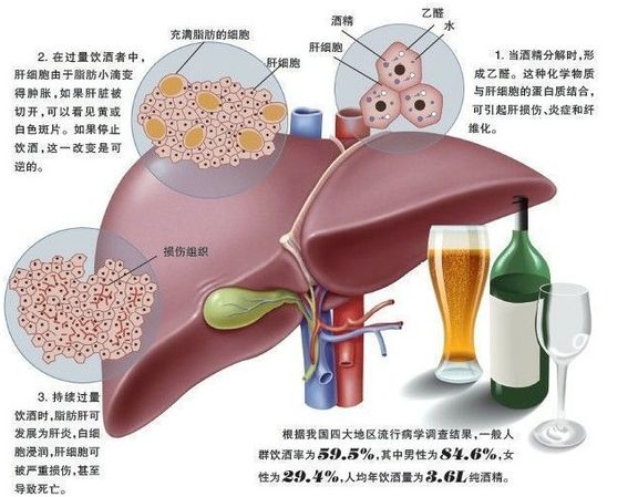 爱喝酒的人注意了,为啥会得酒精肝?? 哔哩哔哩
