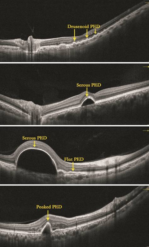 OCT的应用与解读 NOTE（二） - 哔哩哔哩