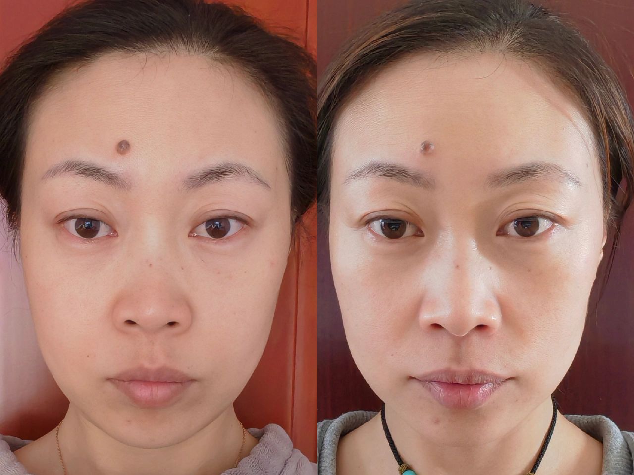 超声炮的功效和作用,超声炮效果如何?值得做吗? 哔哩哔哩