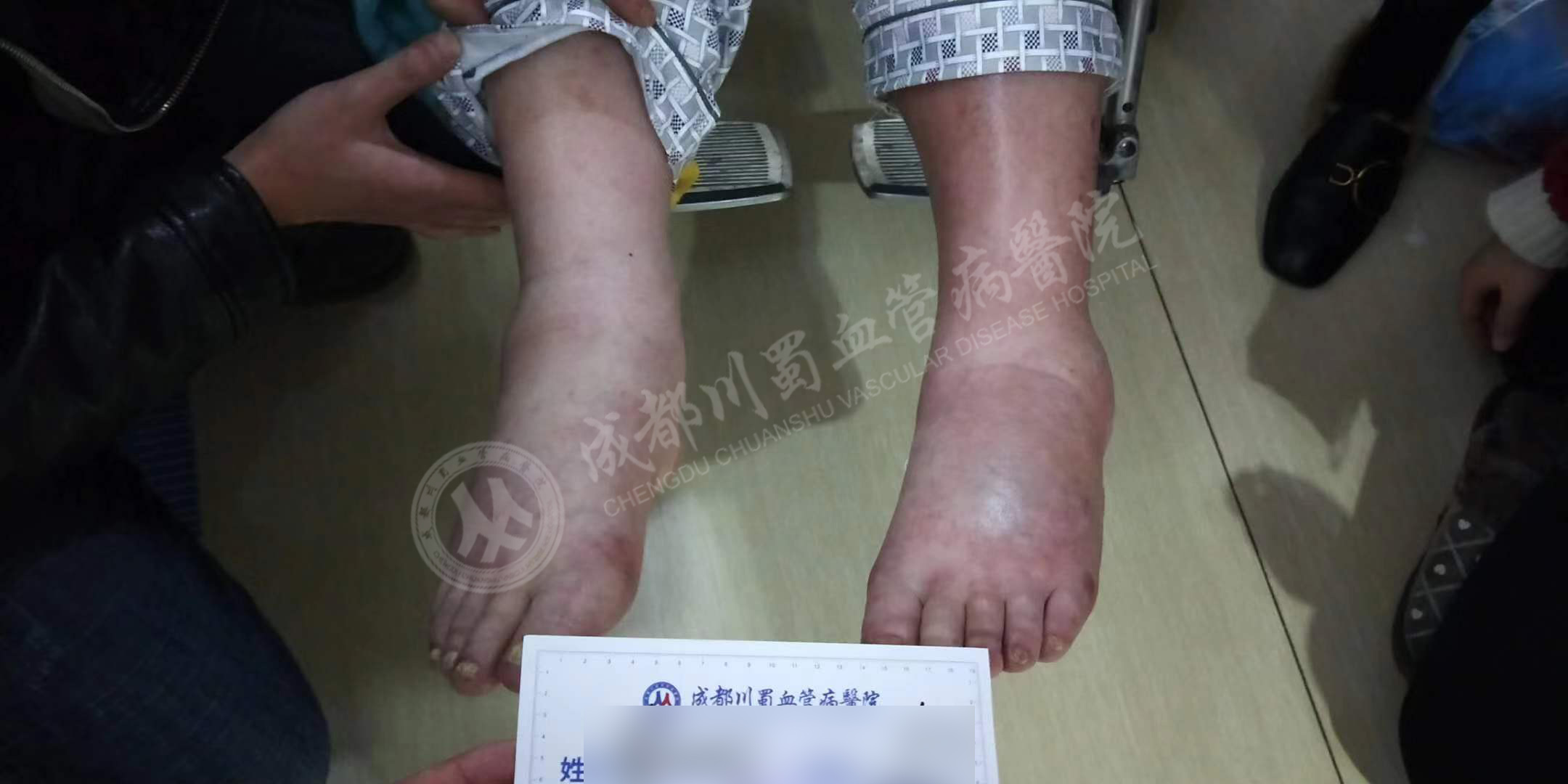 血栓性静脉炎怎么治疗 哔哩哔哩