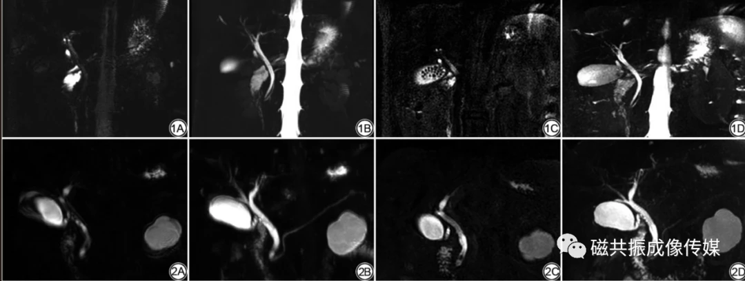 3D BH-GRASE序列MRCP对肝外胆系结石诊断价值的初步研究 - 哔哩哔哩