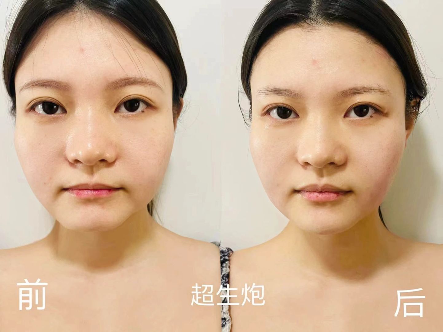 超声炮初体验,超声炮效果好吗 哔哩哔哩
