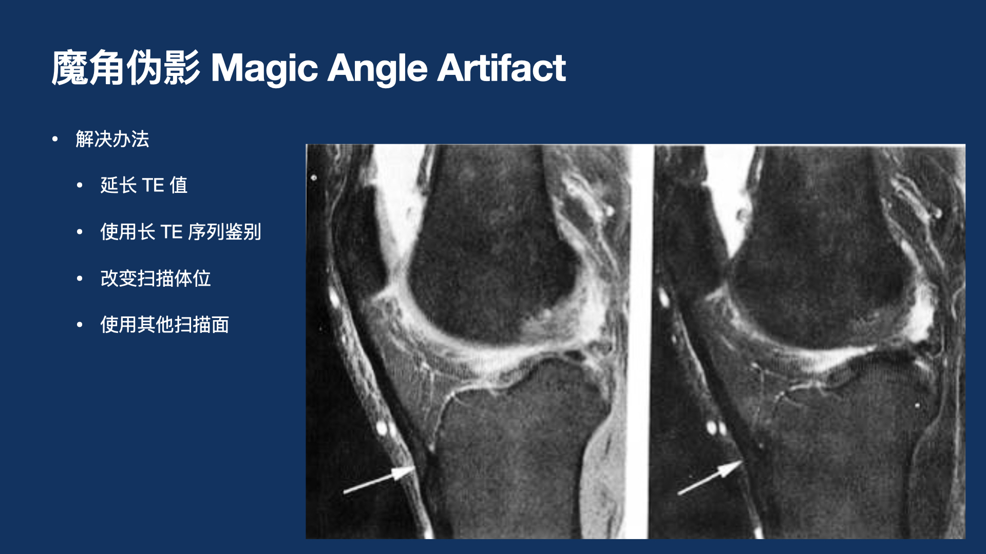 魔角伪影 Magic Angle Artifact丨MRI伪影 - 哔哩哔哩