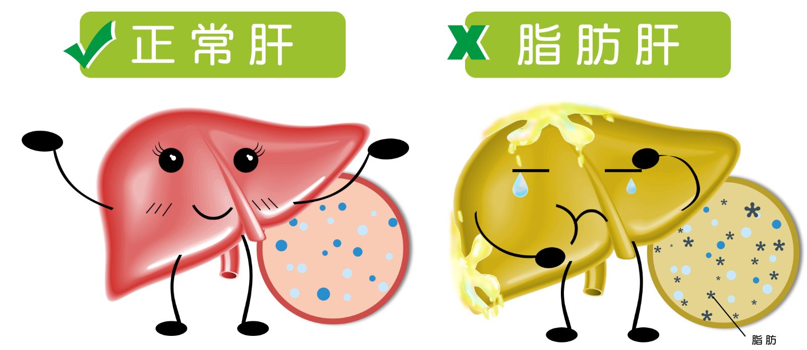 查出脂肪肝，你还觉得没什么危害吗？风险远不止肝炎 哔哩哔哩