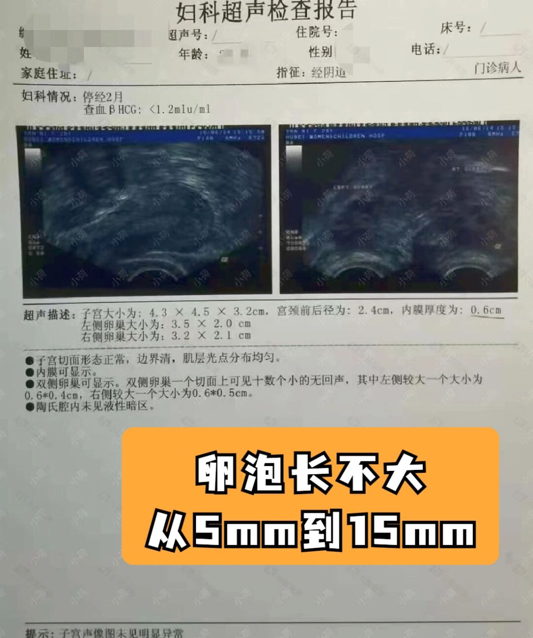 卵泡发育不好怎么调理,怎么提高卵泡质量 哔哩哔哩