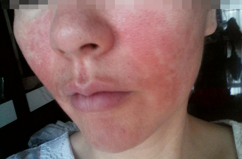 冰电波拉皮多久做一次、频繁做冰电波拉皮后的副作用别说你不知道 哔哩哔哩