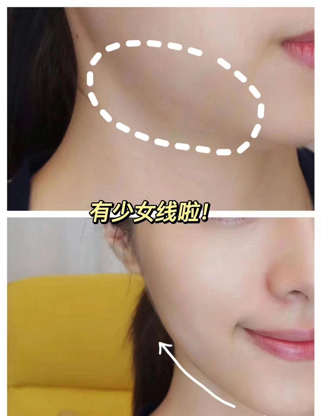 超声炮失败后脸会垮掉吗,超声炮术后护理和注意事项 哔哩哔哩
