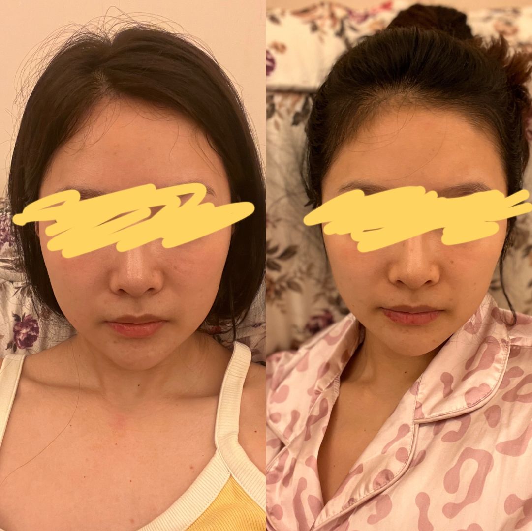 超声炮多久效果最好?超声炮术后护理和注意事项 哔哩哔哩