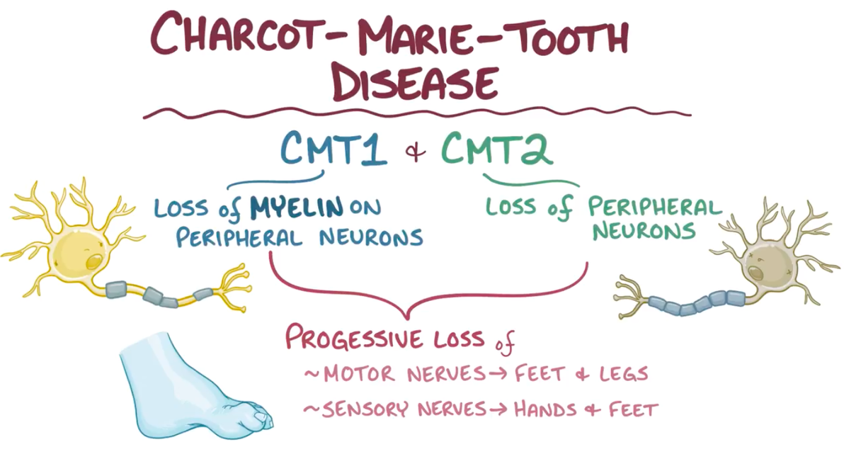 【Osmosis医学】腓骨肌萎缩症 Charcot-Marie-Tooth Disease - 哔哩哔哩