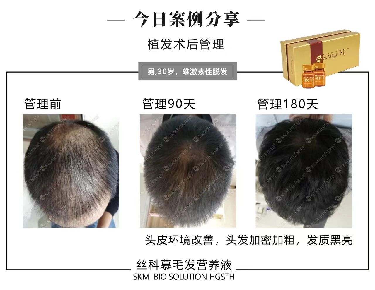 斑秃了还能长回来吗 哔哩哔哩