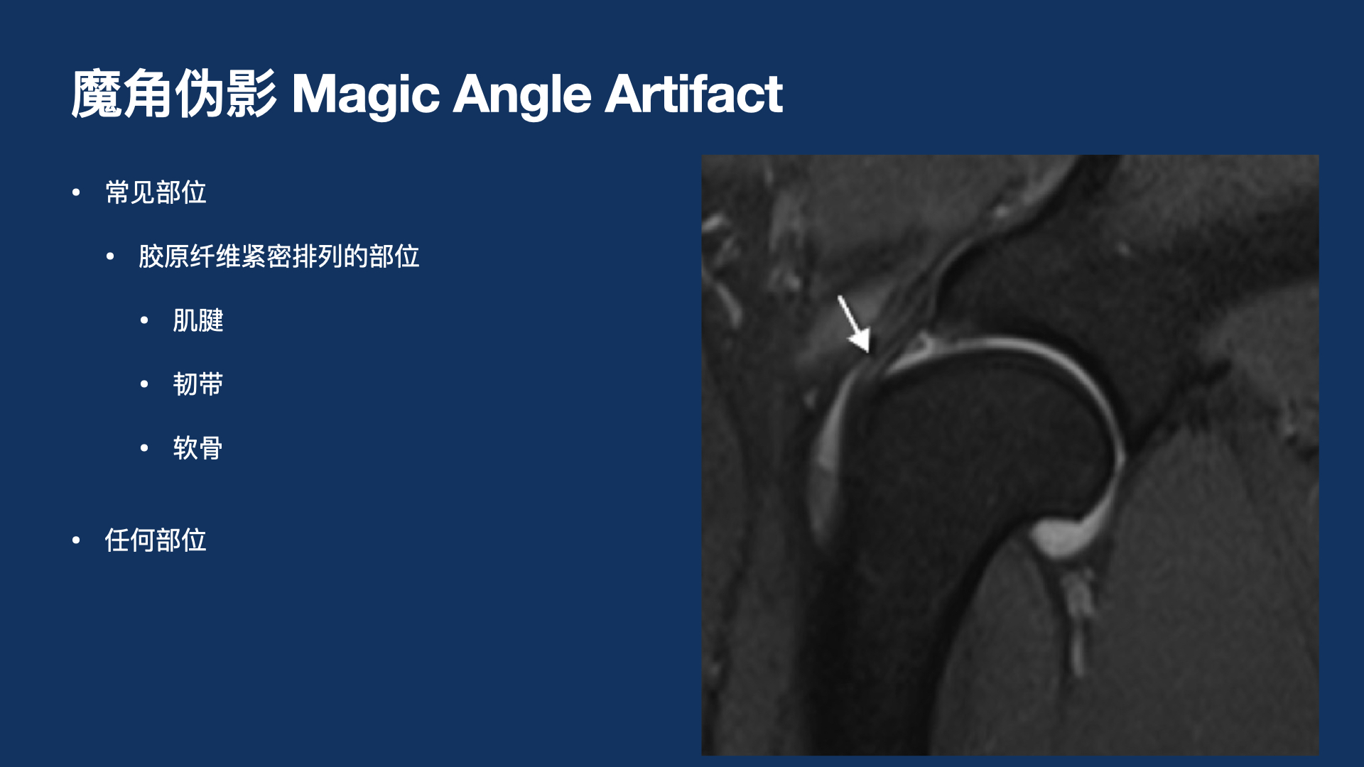 魔角伪影 Magic Angle Artifact丨MRI伪影 - 哔哩哔哩