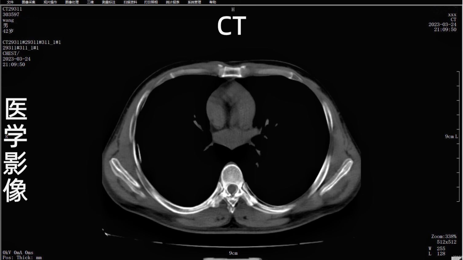 【C++医学影像PACS】CT检查中的三维重建是什么检查？ - 哔哩哔哩