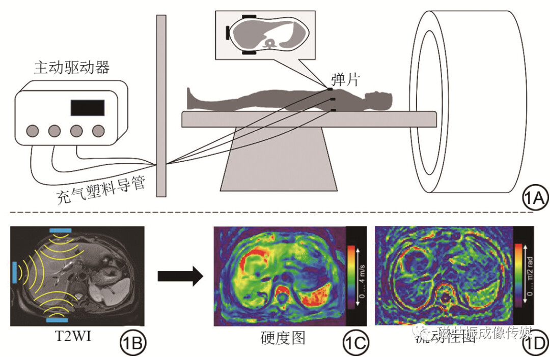 磁共振弹性成像在肝细胞癌诊疗评估中的研究进展 - 哔哩哔哩