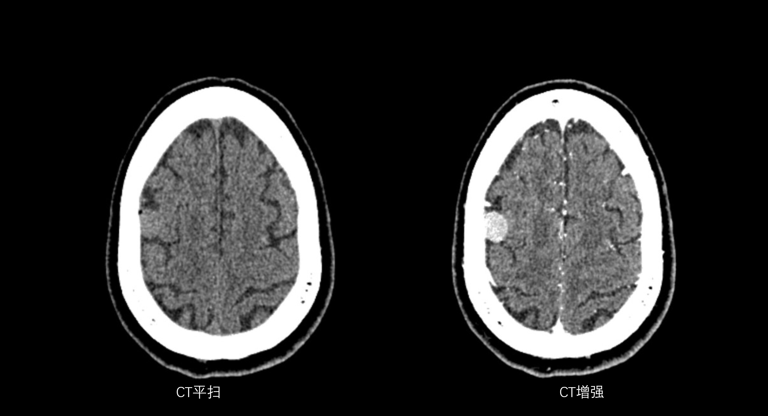 医学影像诊断病例 008期 脑膜瘤 - 哔哩哔哩