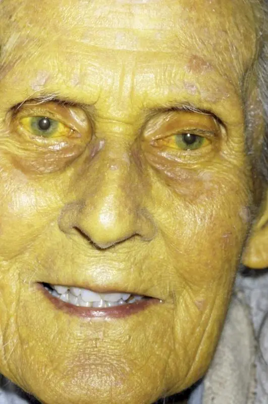 甲肝是一种怎样的传染病？为何会在1988年的上海大爆发？ - 哔哩哔哩