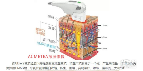 超声炮做完多久有效果有什么副作用、闺蜜30像18她凭啥 哔哩哔哩