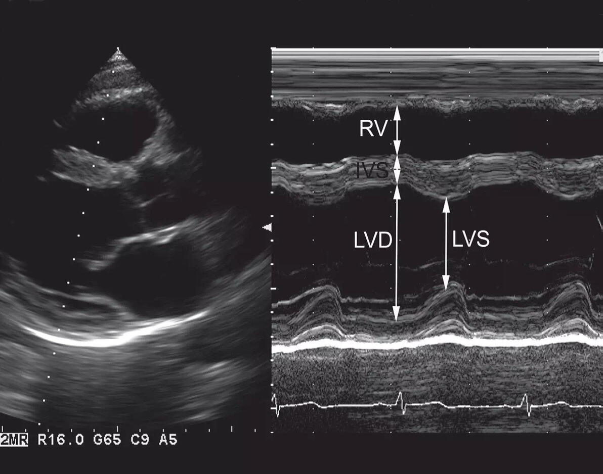 心脏超声-细讲左心室射血分数 (LVEF) - 哔哩哔哩