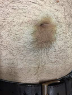 耳熟能详的 Cullen 征和 Grey-Turner 征，不止见于急性胰腺炎 - 哔哩哔哩