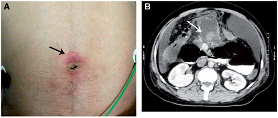 耳熟能详的 Cullen 征和 Grey-Turner 征，不止见于急性胰腺炎 - 哔哩哔哩