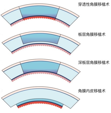 有医说一：角膜成分移植术才是角膜医生一直追寻的答案 - 哔哩哔哩